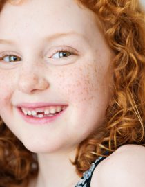 Lupus in Children: How Common Is Childhood Lupus?